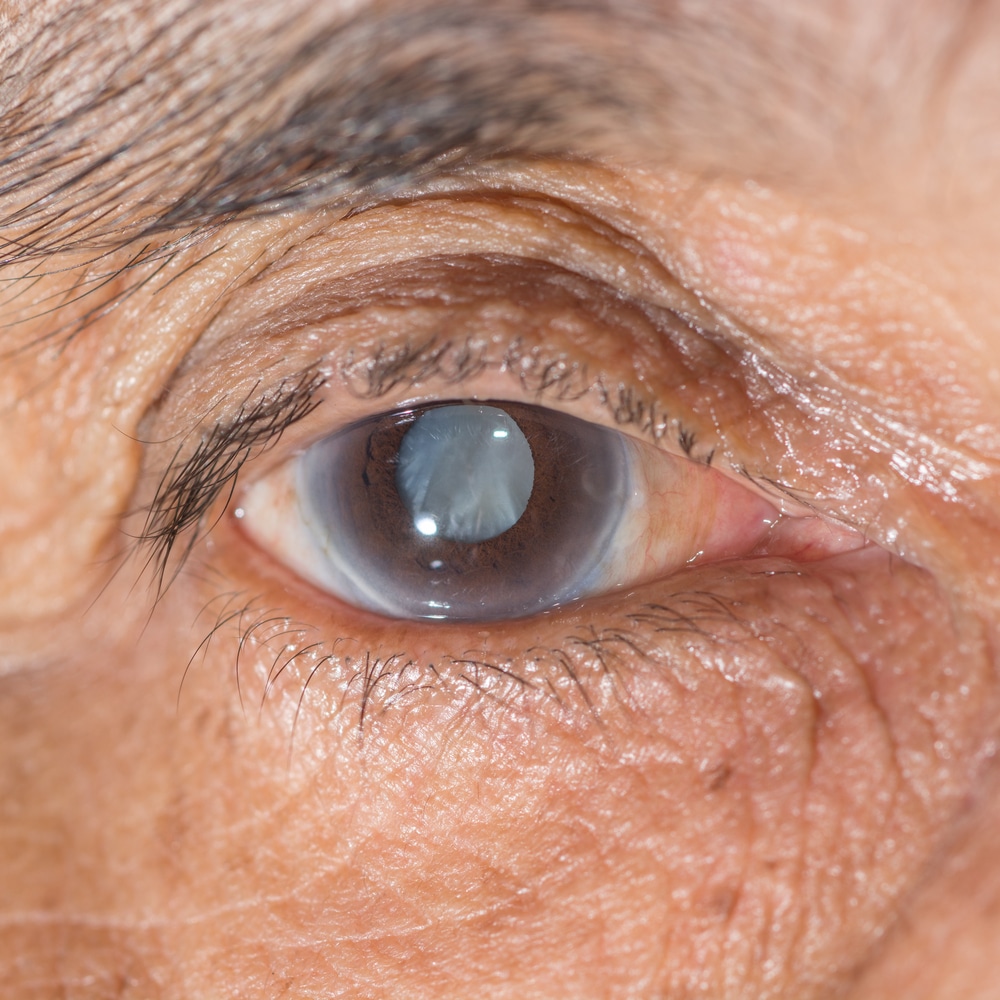 PHOTOS: Top 3 Early Signs of Cataracts in 2020 - Eye Center of Texas