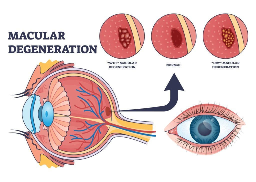 Can Macular Degeneration Be Cured Eye Center Of Texas