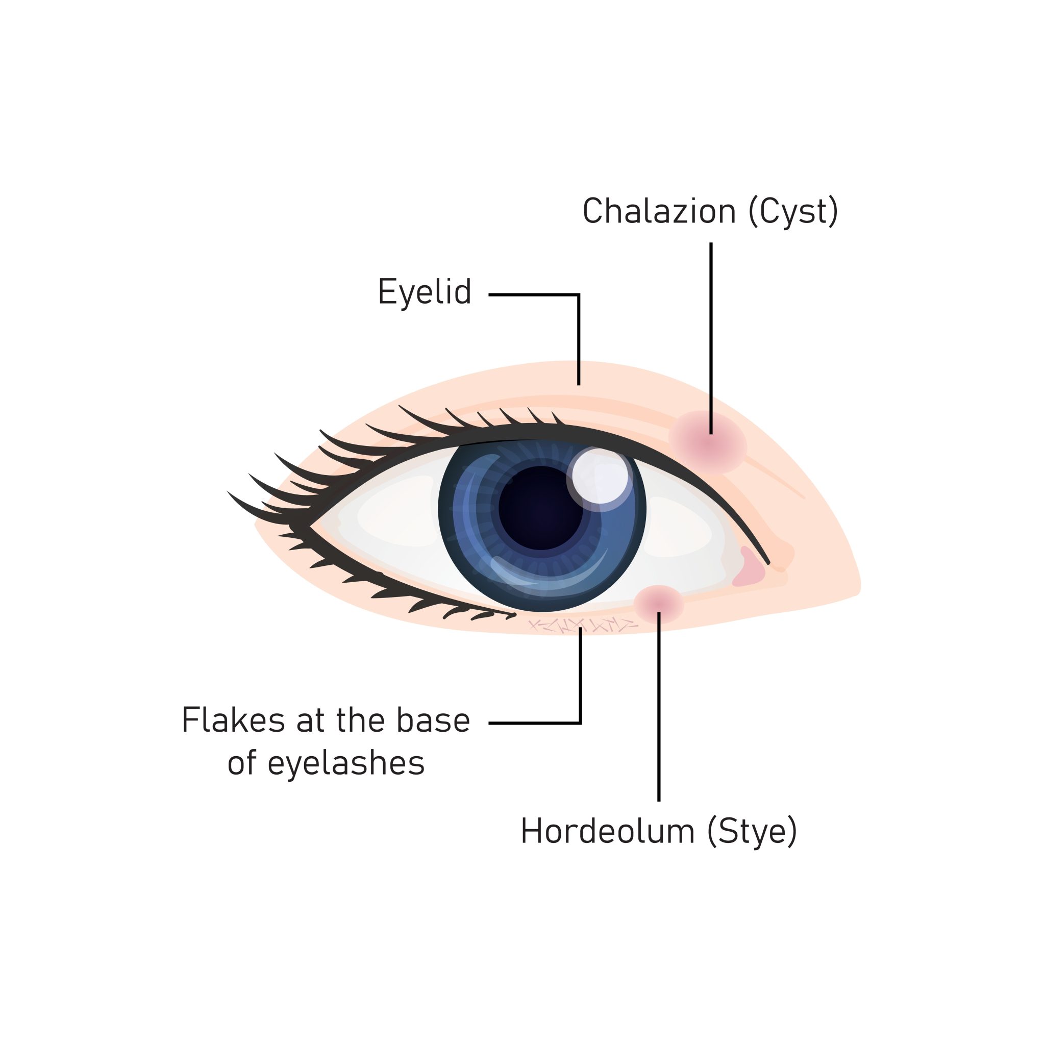 What Causes White Bumps on the Eyelid? - Eye Center of Texas