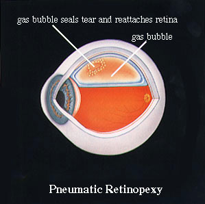 Retinal Tears & Detachment | Eye Center of Texas