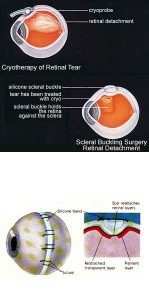 Retinal Tears & Detachment | Eye Center of Texas