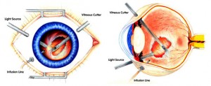 Retinal Tears & Detachment | Eye Center of Texas