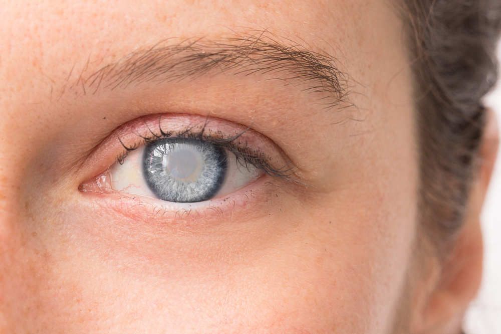 Fast Growing Cataracts How To Fight Them Eye Center Of Texas Fast Growing Cataracts How To Fight Them Eye Center Of Texas